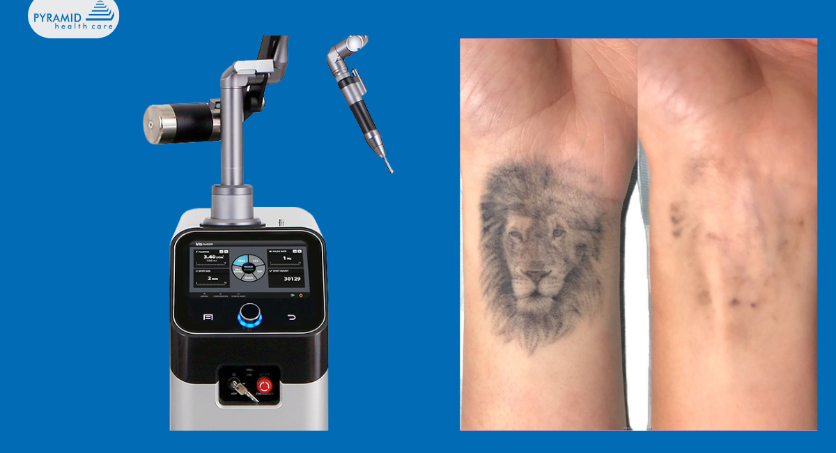 Laser Tattoo Removal Machine or Home Use which one is good?