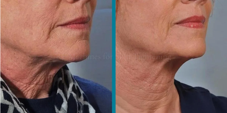 How Dermatologists Use RF Machine for Skin Tightening